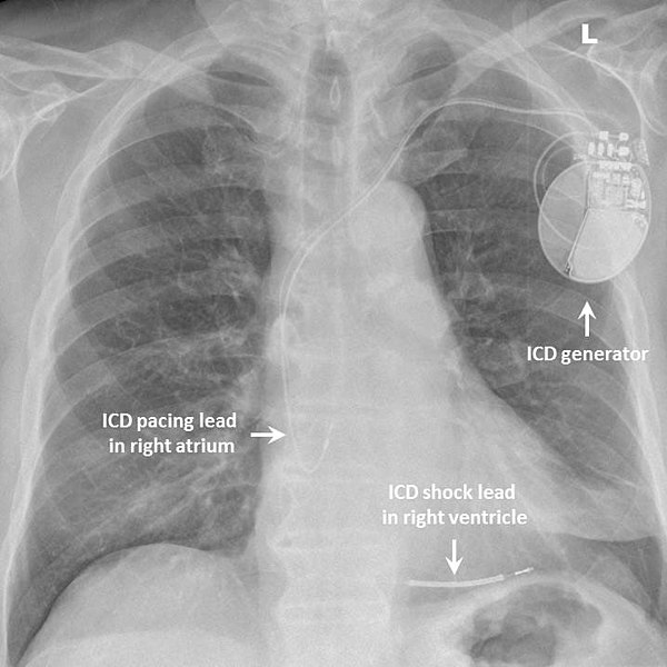 Radiology: Abnormal Chest X-Rays Part I – Glass Box Medicine