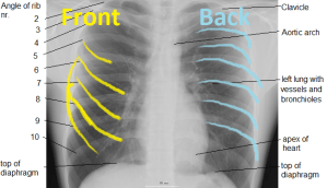 Radiology: Normal Chest X-Rays – Glass Box Medicine