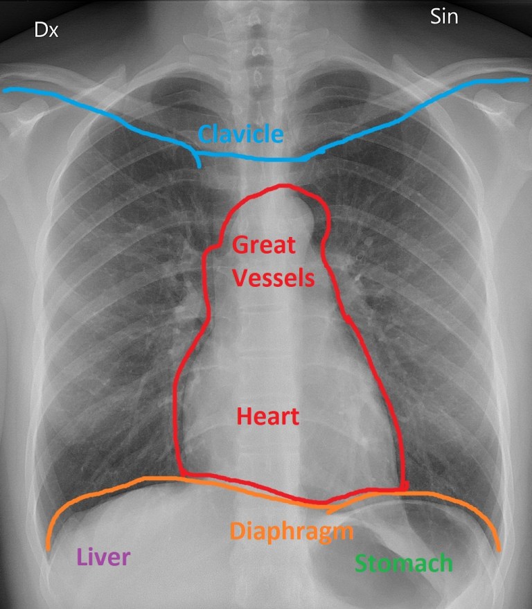 Radiology: Normal Chest X-Rays – Glass Box Medicine