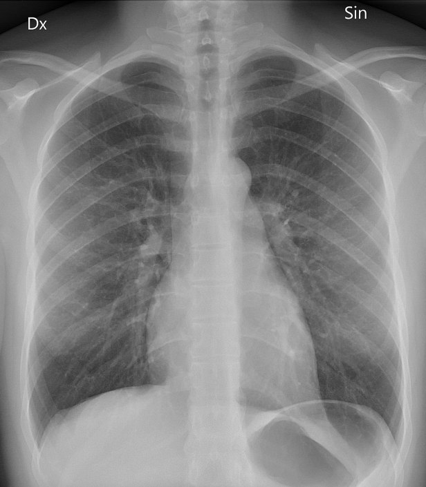 Radiology: Normal Chest X-Rays – Glass Box Medicine