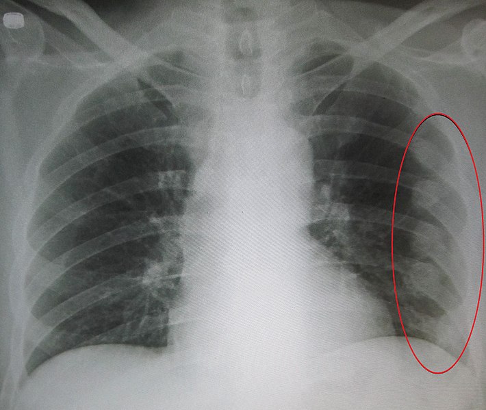 Radiology: Abnormal Chest X-Rays Part II – Glass Box Medicine
