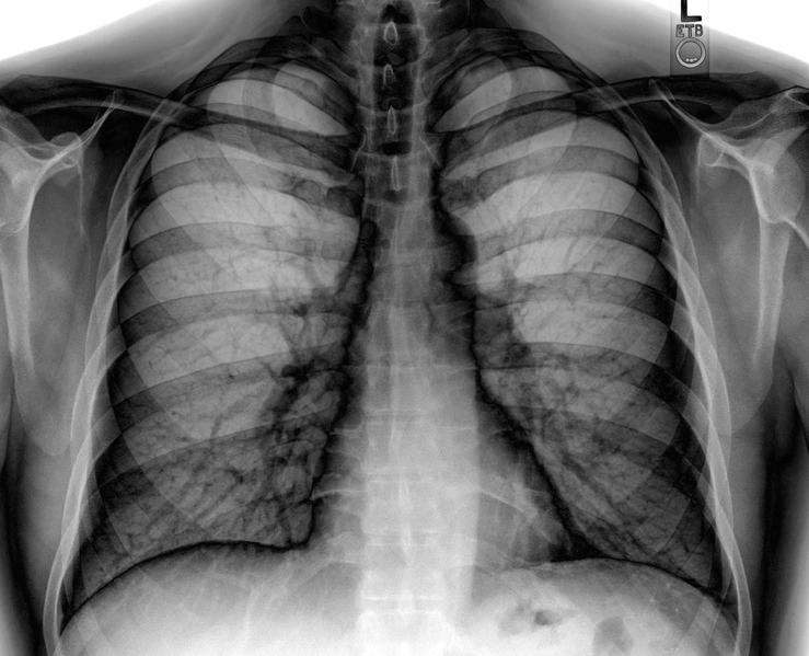Radiology: Abnormal Chest X-Rays Part III – Glass Box Medicine