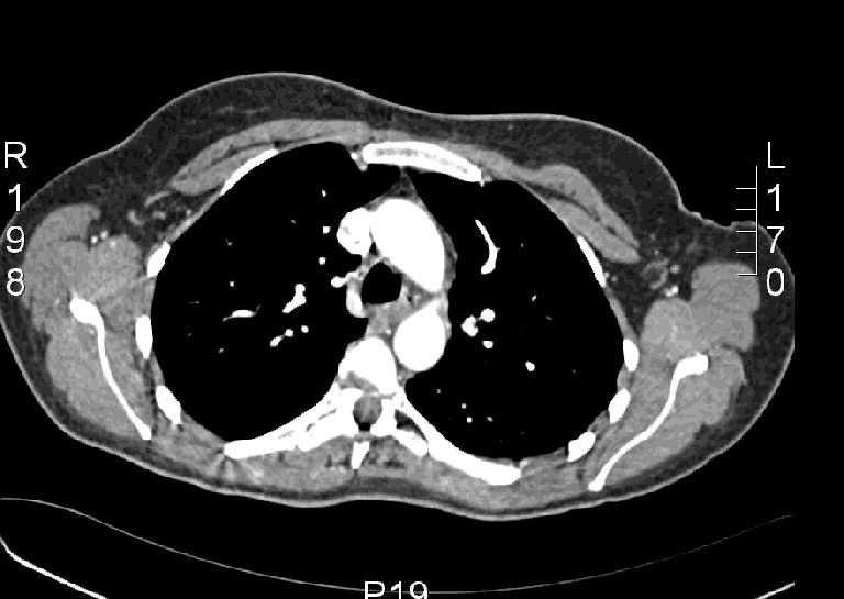 Automatic Interpretation of Chest CT Scans with Machine Learning ...