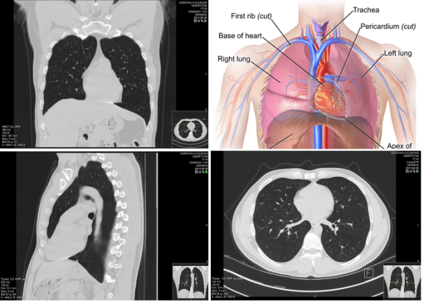 Automatic Interpretation of Chest CT Scans with Machine Learning ...