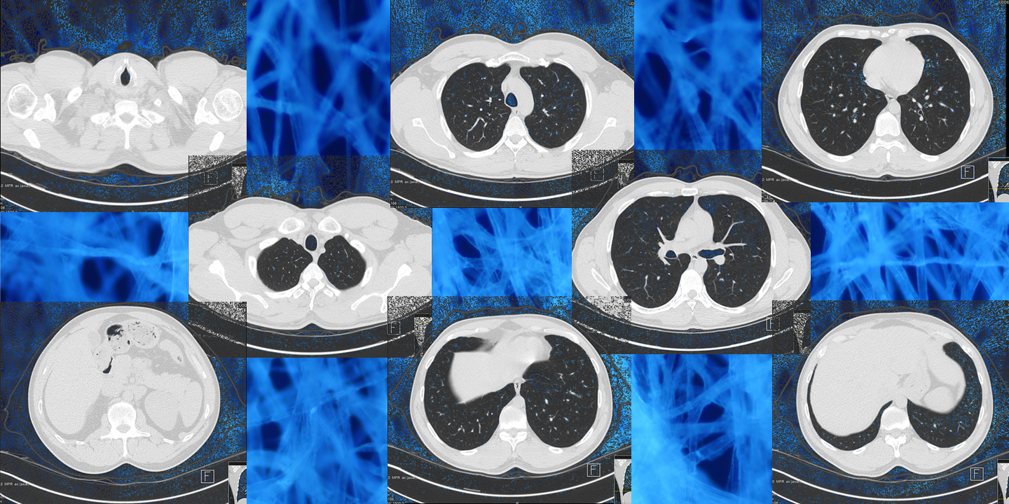 RAD-ChestCT: Publicly Available Multi-Abnormality CT Scan Dataset ...