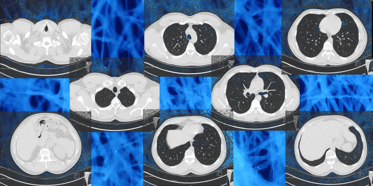 RAD-ChestCT: Publicly Available Multi-Abnormality CT Scan Dataset ...